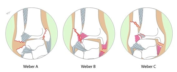 Image - Sprunggelenksfraktur - weber-klassifikation thun.jpg | Unfall ...